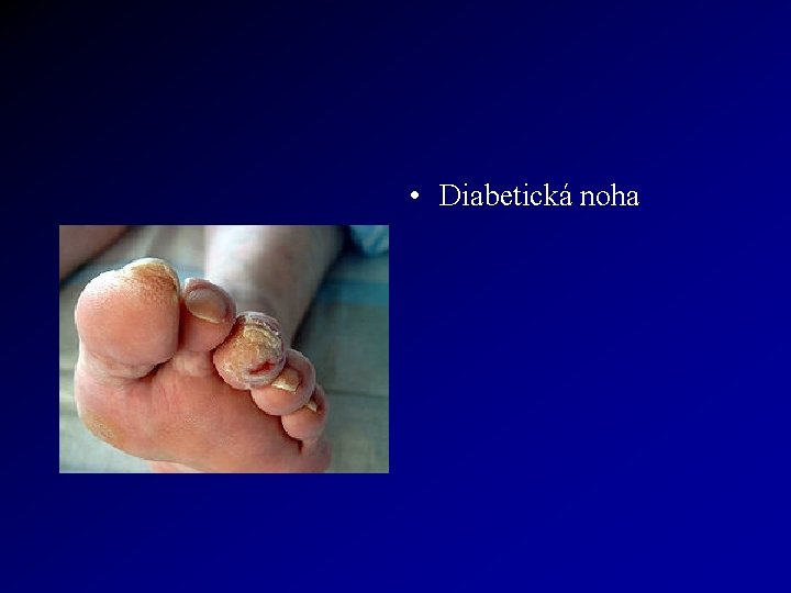 DIABETES MELLITUS dtsk cukrovka Zuzana Hradilov Co je