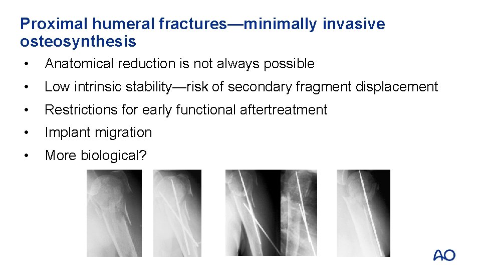 Proximal humeral fracturesan update on treatment protocols AO