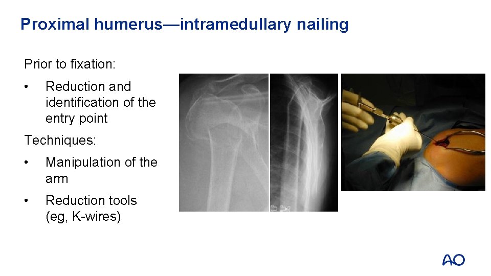 Proximal humeral fracturesan update on treatment protocols AO