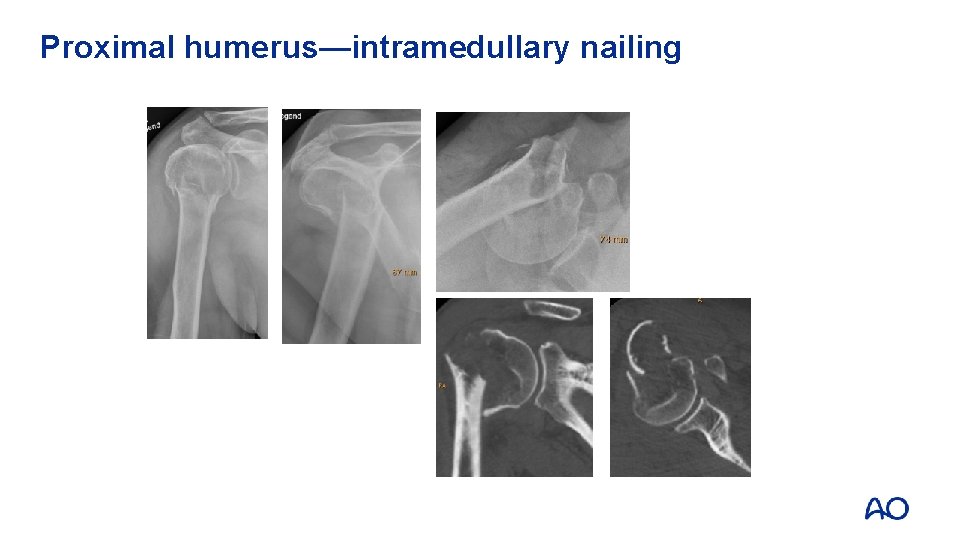 Proximal humeral fracturesan update on treatment protocols AO