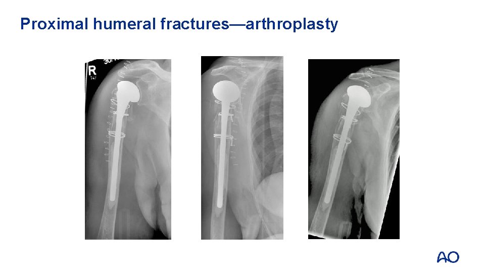 Proximal humeral fracturesan update on treatment protocols AO