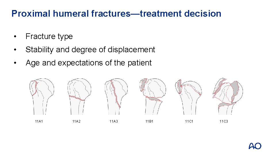 Proximal humeral fracturesan update on treatment protocols AO