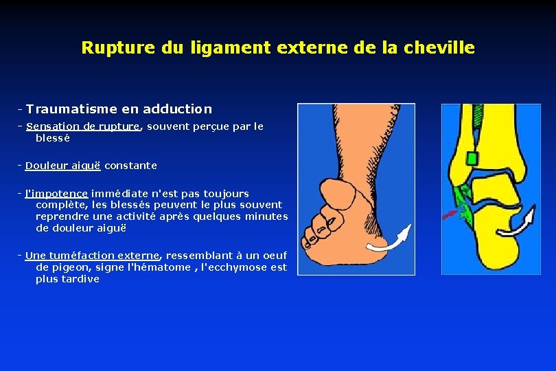Traumatologie de la cheville La mortaise et le