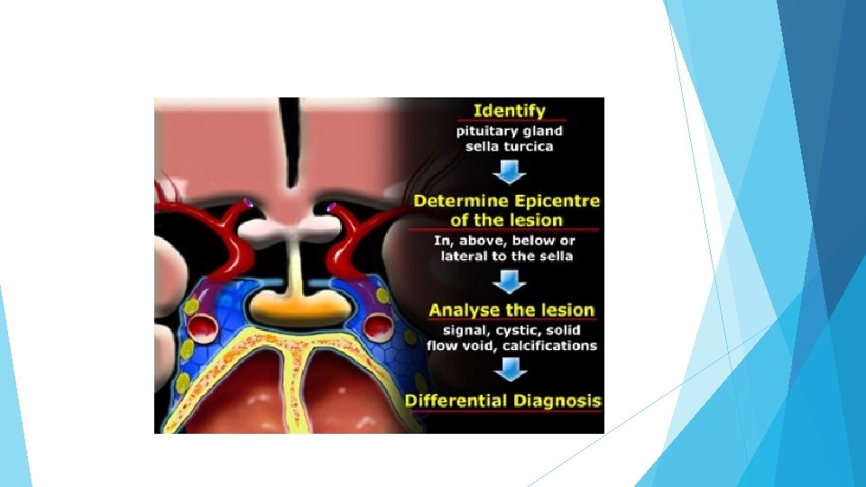 Sella Turcica and Parasellar Region F Niaghi MD