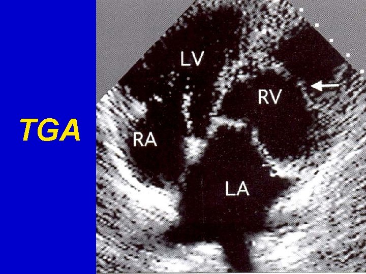 CONGENITAL HD Overview RAGAB ABDELSALAM MD Prof of
