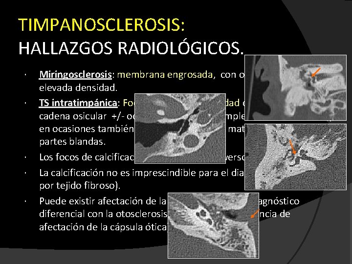 TIMPANOSCLEROSIS A Estremera R H Sarasibar E G