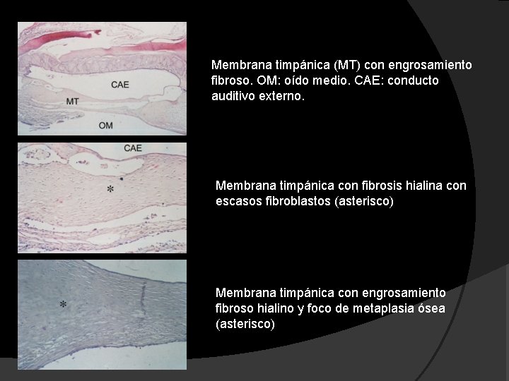 TIMPANOSCLEROSIS A Estremera R H Sarasibar E G