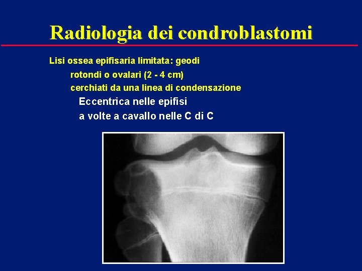 Condroblastoma benigno Condroblastoma benigno Tumore cartilagineo ...