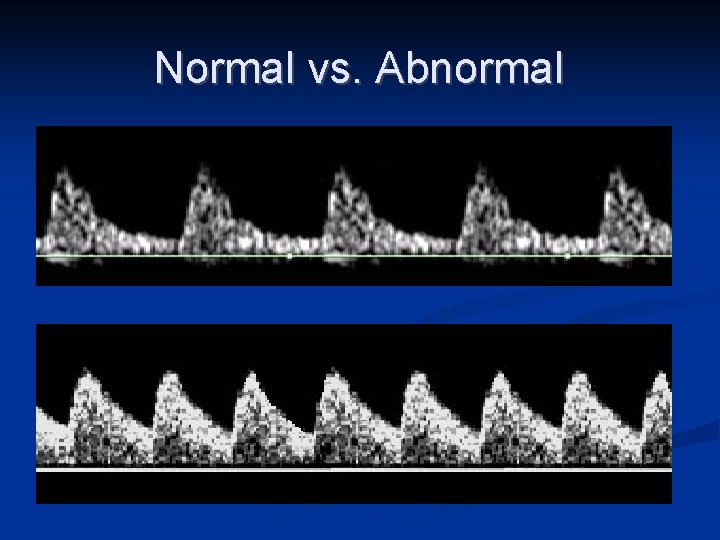 Middle Cerebral Artery Doppler Ultrasound By Erik Paulson