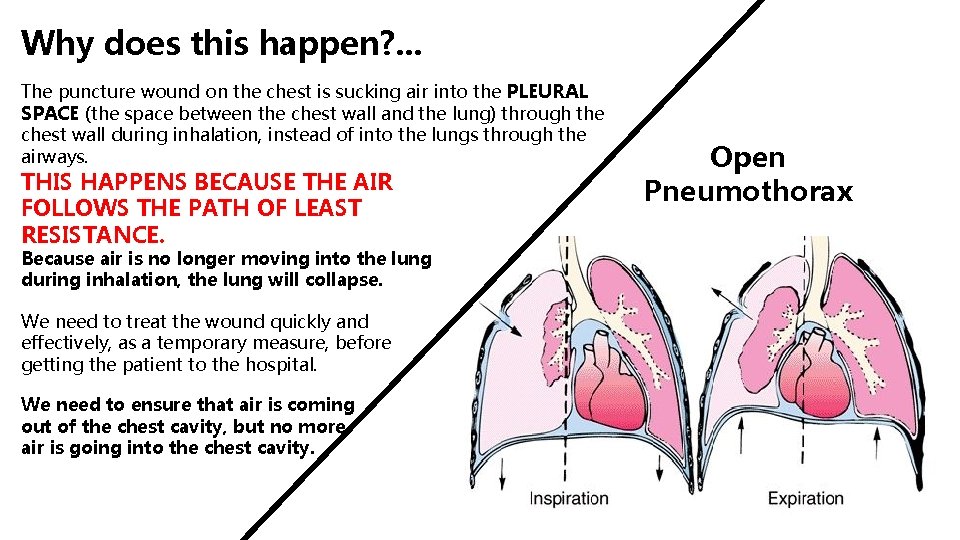 Lung Trauma By Dr Ben Siggers and Jason