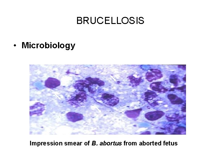 BRUCELLOSIS Brucellosis Other names Contagious abortion Bangs disease
