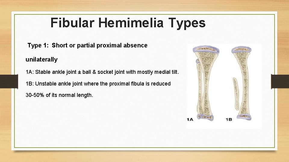 Group 3 Fibular Hemimelia Alina Bodea Co Presenter