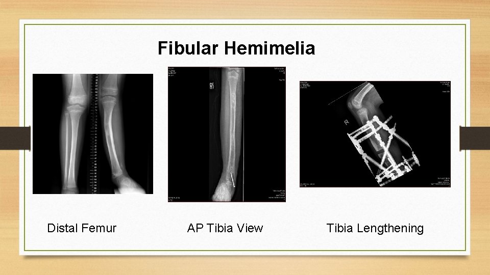 Group 3 Fibular Hemimelia Alina Bodea Co Presenter