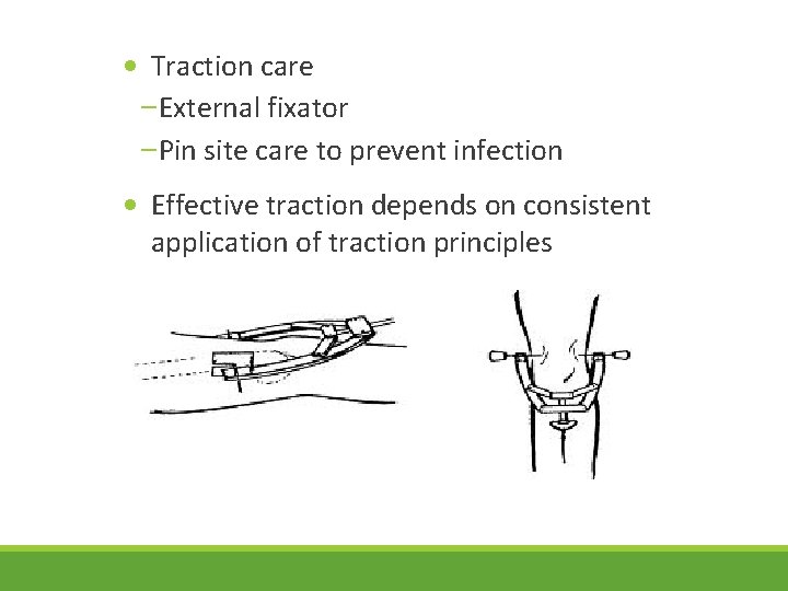 Chapter 25 Mechanical Immobilization Mechanical Immobilization Some people