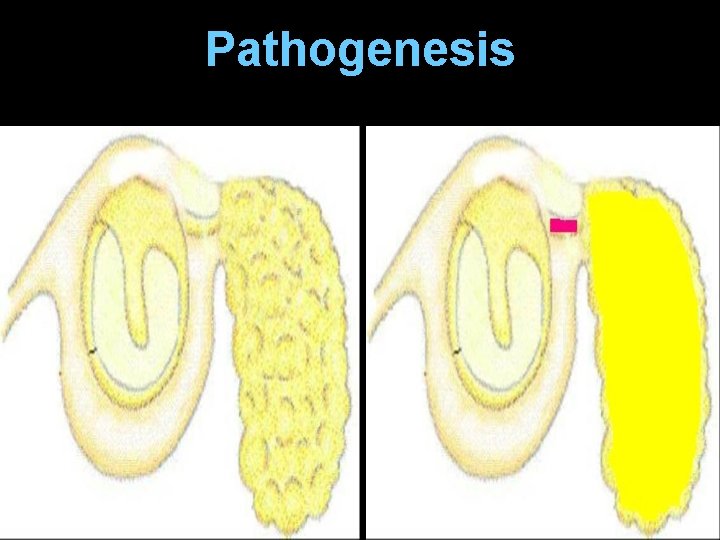 Complications of Suppurative Otitis Media Definition Infection spreads