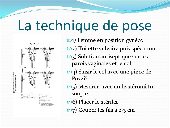 Technique de pose du DIU Quand En labsence