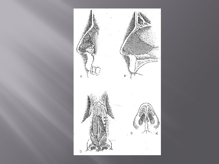 THE DEVIATED NOSE Dr smr azimi Is the