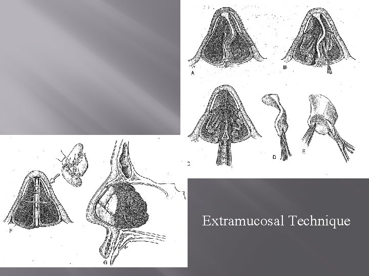 THE DEVIATED NOSE Dr smr azimi Is the