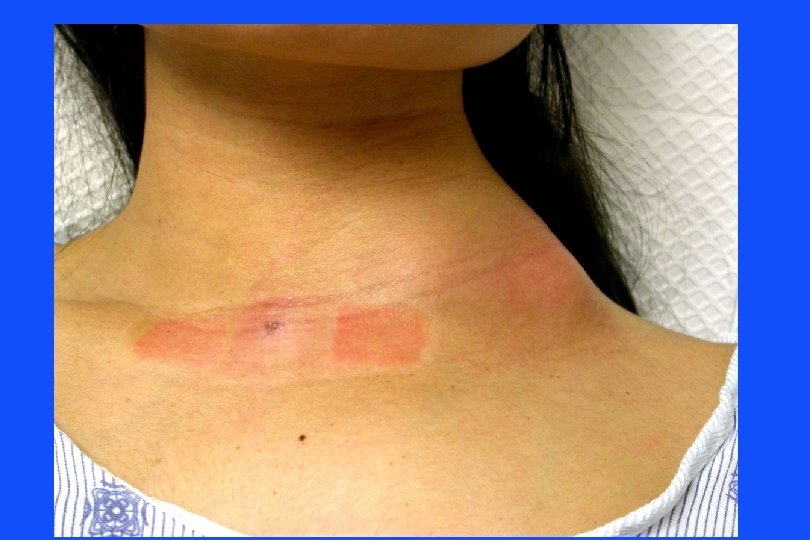 New England TB Case Series January 18 2006