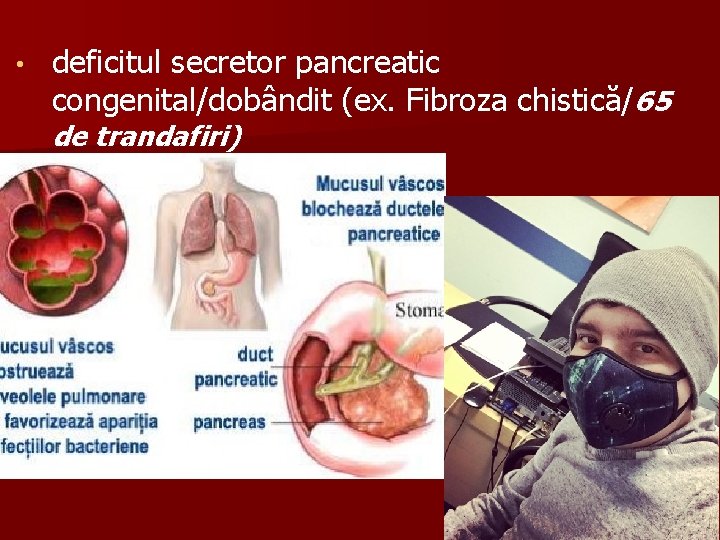 FIZIOPATOLOGIA MALABSORBIEI Mecanismele patogenetice 1 2 3 4