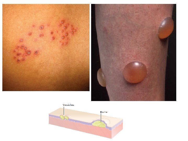 Blistering Diseases Abdulmajeed Alajlan Associate Professor Hair Transplant