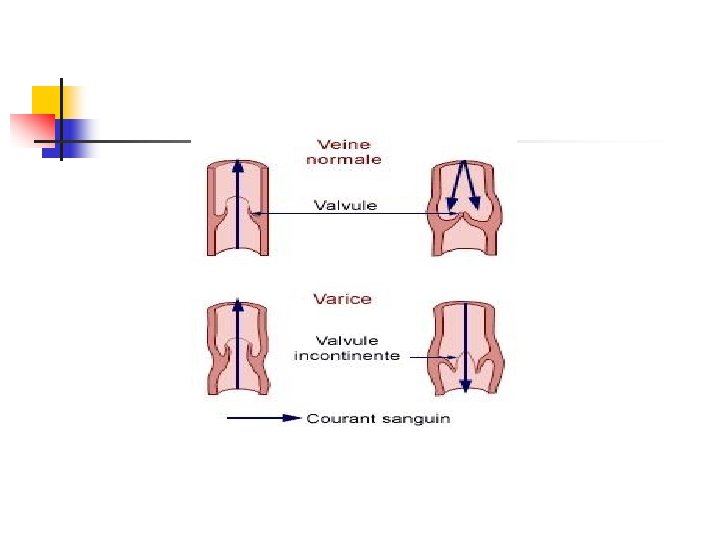 Insuffisance veineuse chronique des membres infrieurs lments diagnostiques