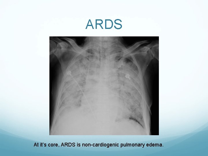 Acute Respiratory Distress Syndrome Outline Definition Low tidal