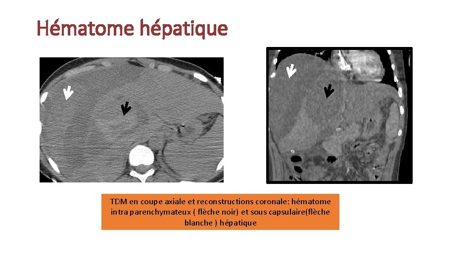 Guide dinterprtation du scanner dans le traumatisme abdominal