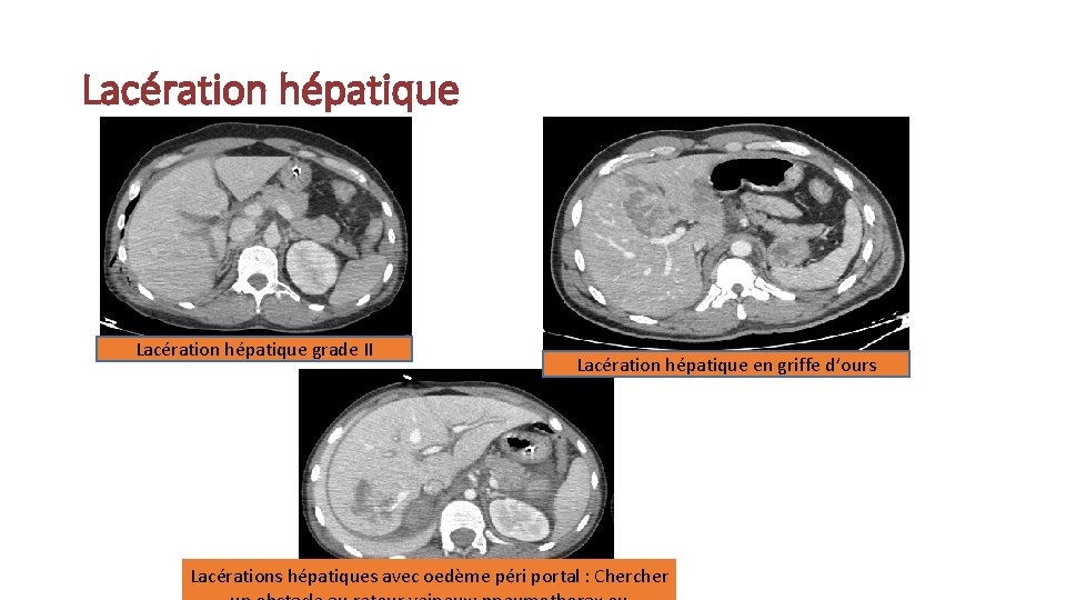 Guide dinterprtation du scanner dans le traumatisme abdominal