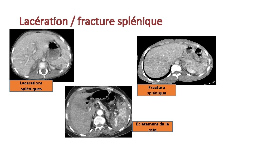Guide dinterprtation du scanner dans le traumatisme abdominal