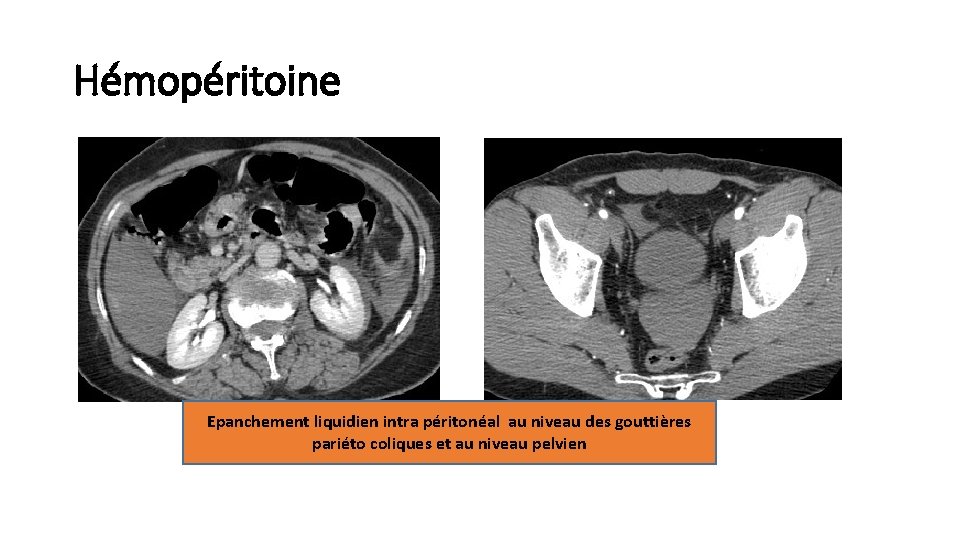 Guide dinterprtation du scanner dans le traumatisme abdominal