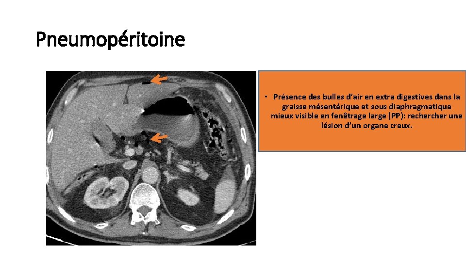 Guide dinterprtation du scanner dans le traumatisme abdominal
