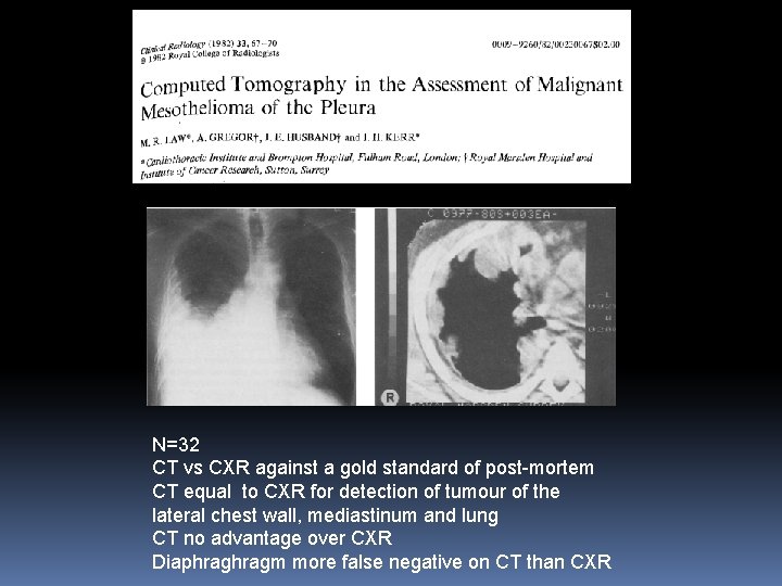 IMAGING THE UNILATERAL EFFUSION CXR AND CT Dr