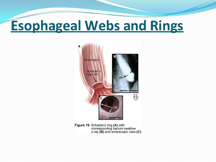 MANAGEMENT OF DYSPHAGIA Dysphagia Difficulty in swallowing which