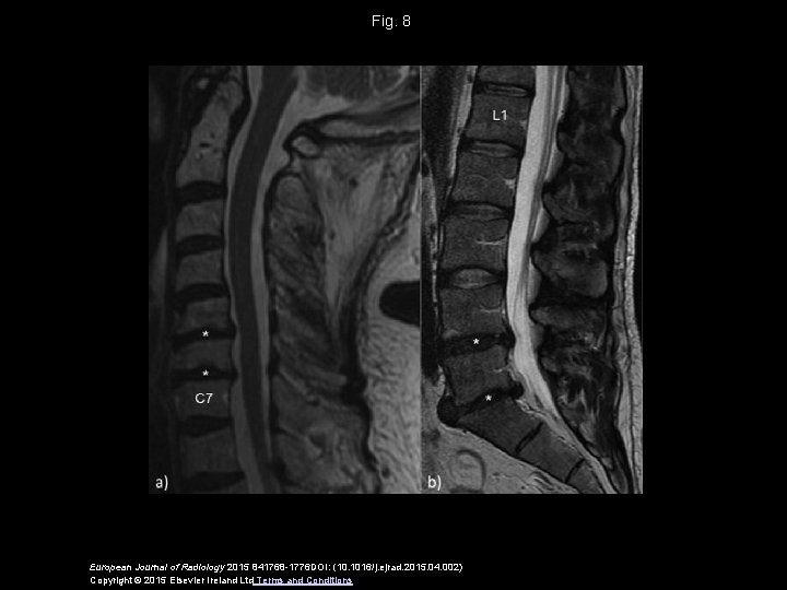 MR imaging of degenerative disc disease Nadja A