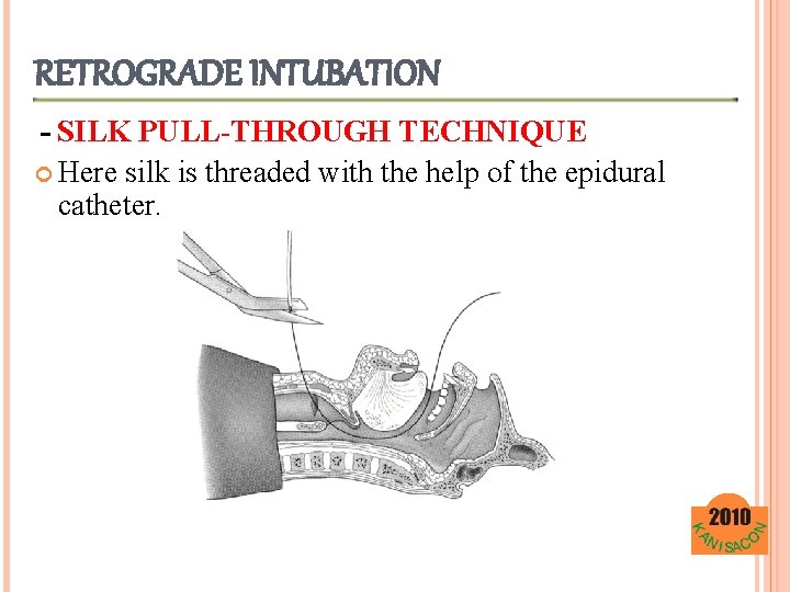 INFRAGLOTTIC INVASIVE AIRWAYS Dr S A Rajkumar Intensivist