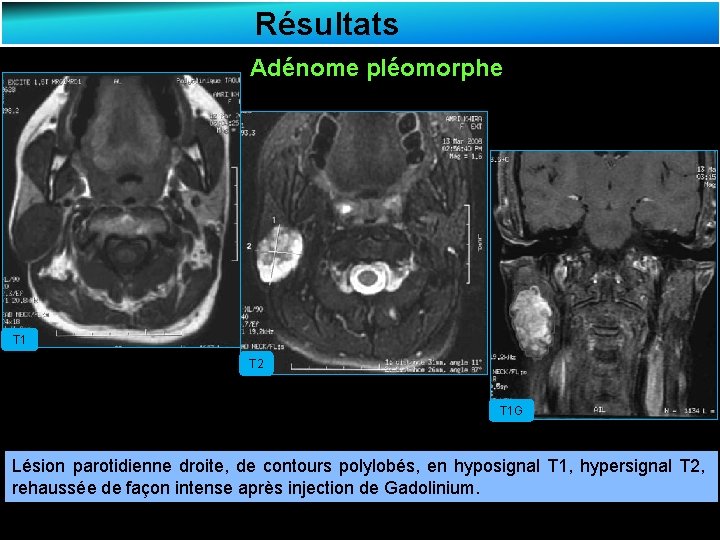Aspect IRM des tumeurs bnignes de la parotide