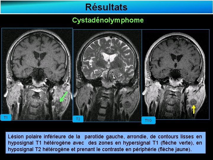 Aspect IRM des tumeurs bnignes de la parotide