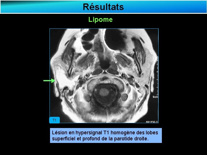 Aspect IRM des tumeurs bnignes de la parotide