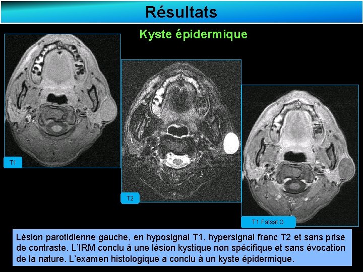 Aspect IRM des tumeurs bnignes de la parotide