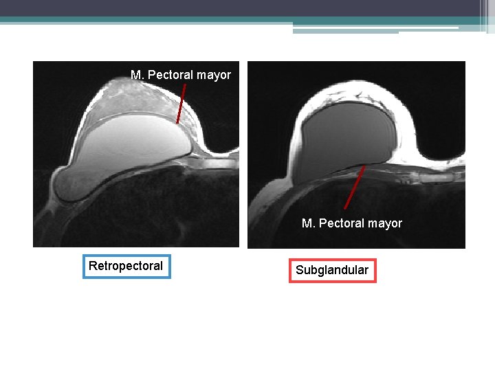 DIAGNSTICO DE LAS COMPLICACIONES DE LAS PRTESIS MAMARIAS