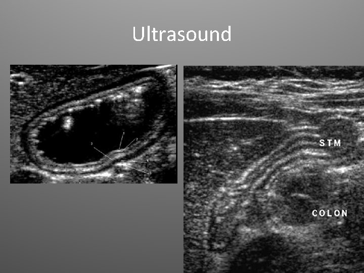 Diagnosis of diverticulosis and diverticulitis Tryggvi Bjrn Stefnsson