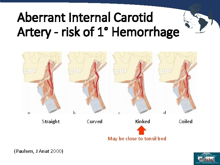 Anesthesia for Post Tonsillectomy and Adenoidectomy Hemorrhage Robin