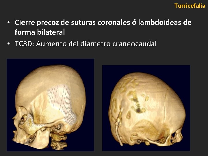 Revisin del Tema Introduccin Se conoce como craneosinostosis