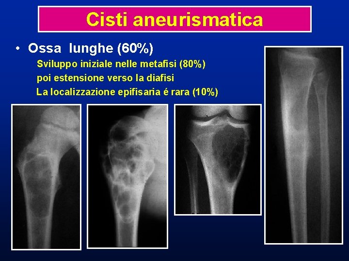 CISTI ANEURISMATICA Cisti aneurismatica Distrofia ossea pseudotumorale ...