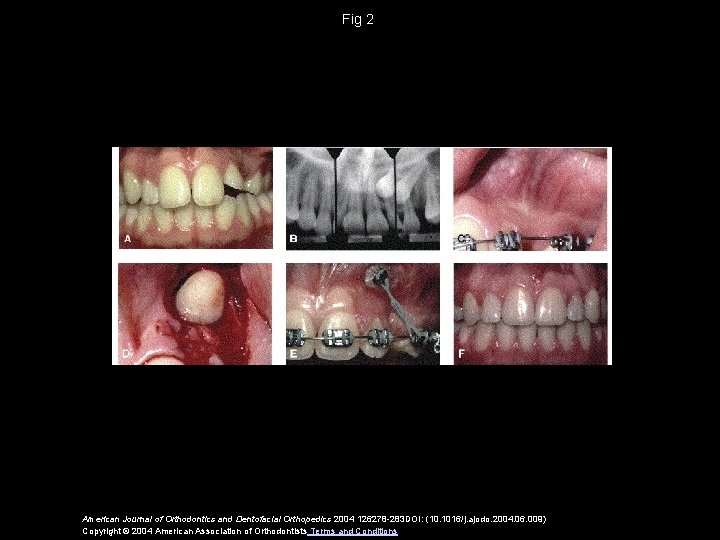 Surgical and orthodontic management of impacted maxillary canines