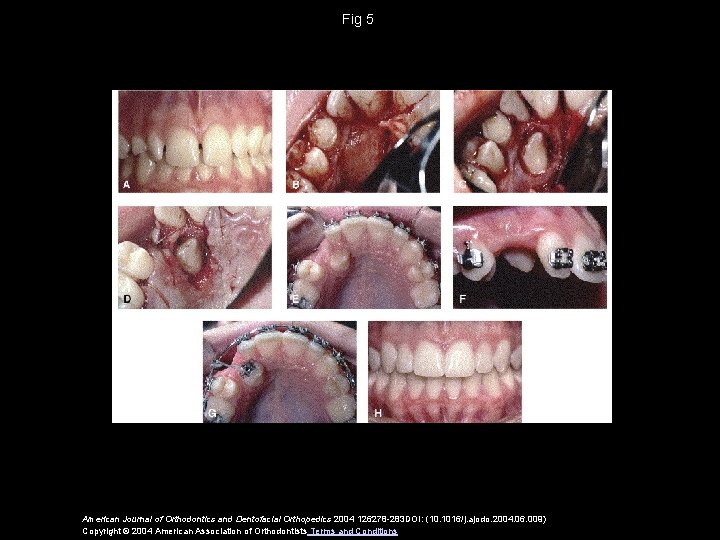 Surgical and orthodontic management of impacted maxillary canines