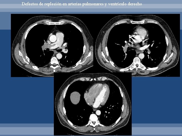 TROMBOEMBOLISMO PULMONAR Clnica Gasometra ECG DmeroD alto VPN