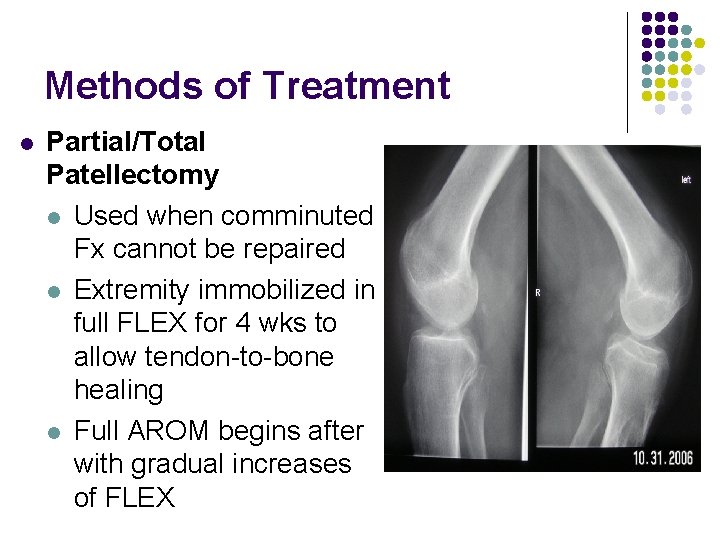 Patellar Fractures RSAT 365 Angie Whittington Classification l
