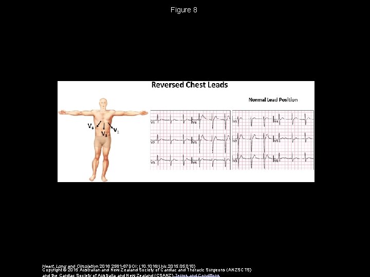 Twisted Leads The Footprints of Malpositioned Electrocardiographic Leads
